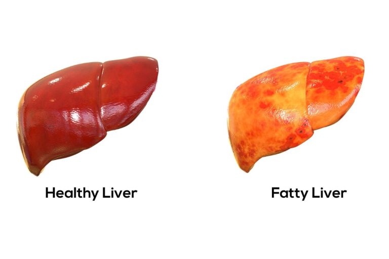 How do Energy Drinks Affect the Liver, Especially with Fatty Liver ...